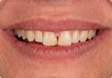 Injection Molding Technique | Direct Restorative