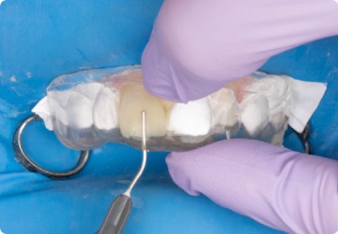 Injection Molding Technique | Direct Restorative