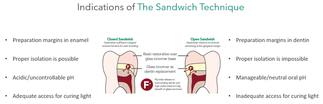 The Sandwich Technique | Direct Restorative