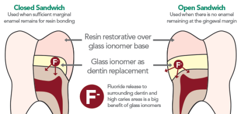 The Sandwich Technique | Direct Restorative